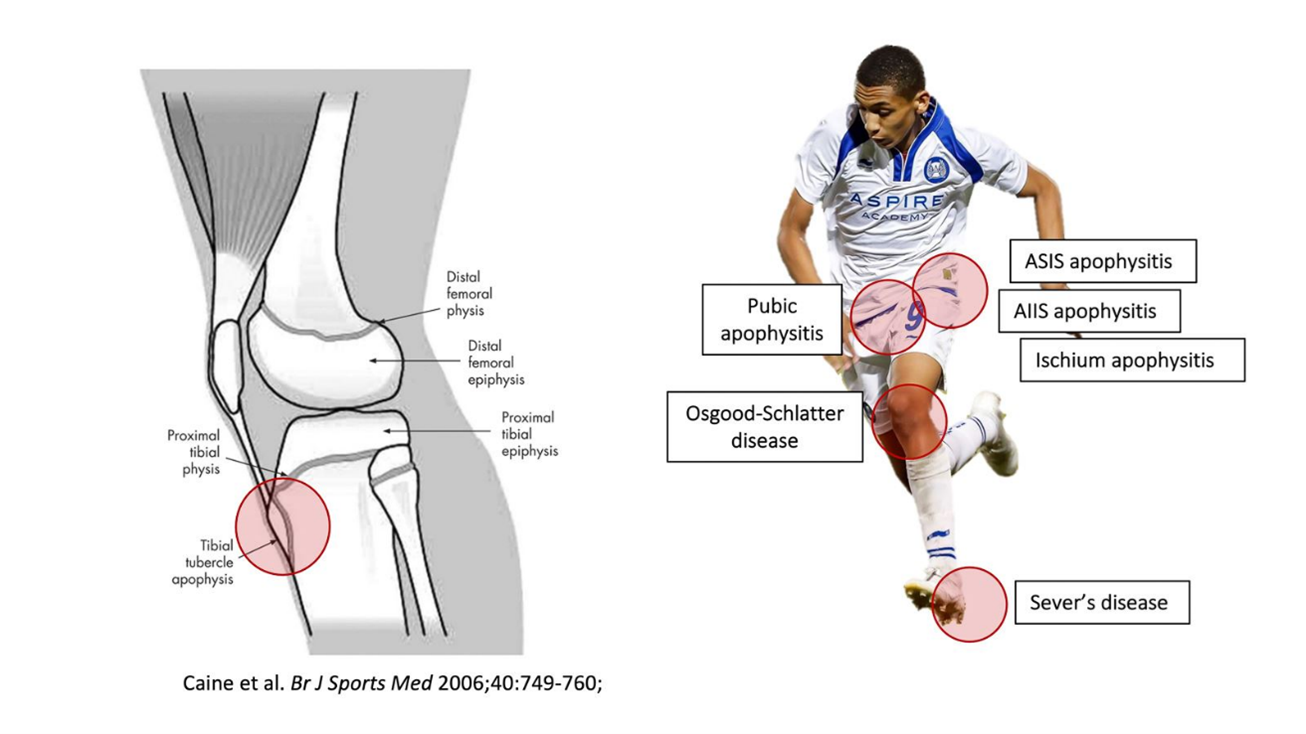 Apophyseal Injuries in Football Players - The Football Physio