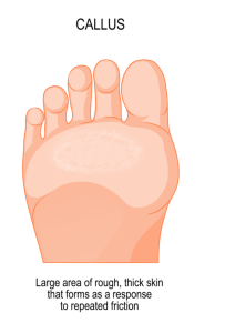 Managing Foot Calluses for Football Players - The Football Physio