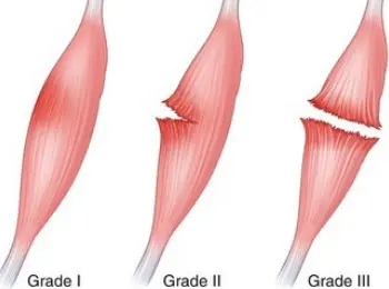 Muscle Strains in Football - The Football Physio