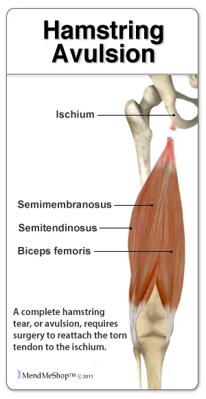 Hamstring Avulsion in Football Players - The Football Physio