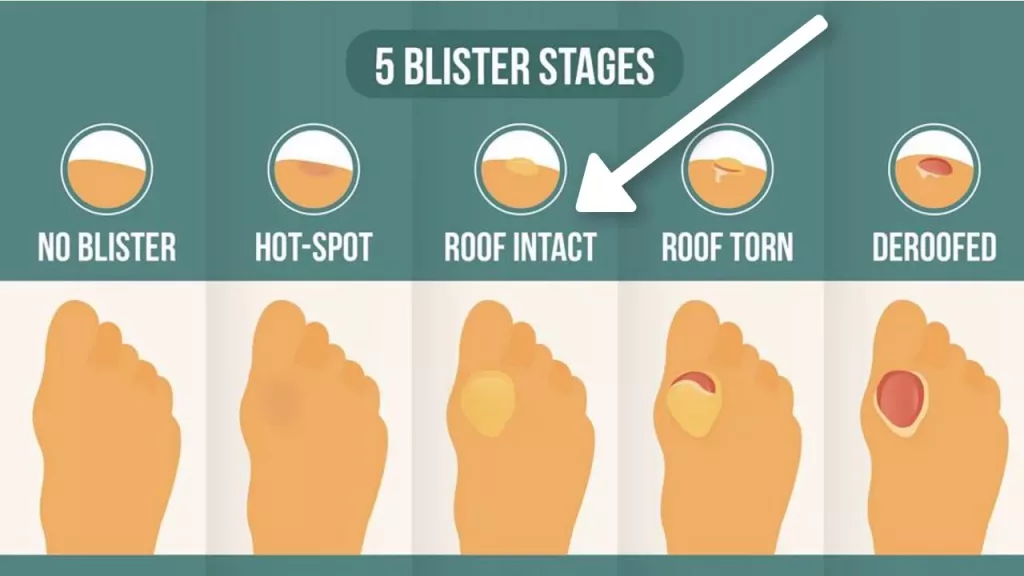 Managing Blisters for Football Players - The Football Physio